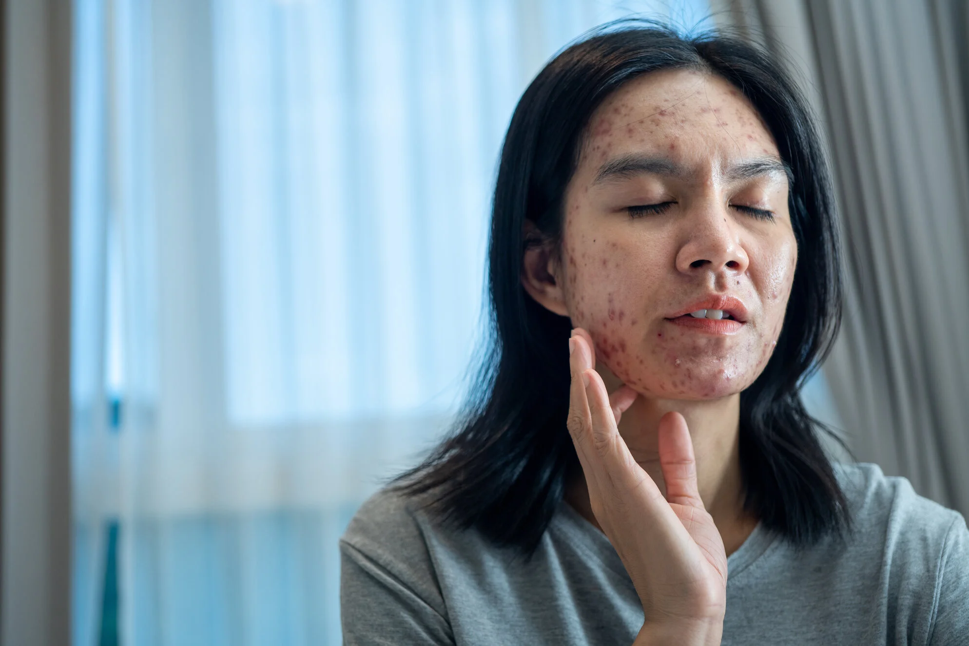 Acne bij volwassene oplossen | EurMedi